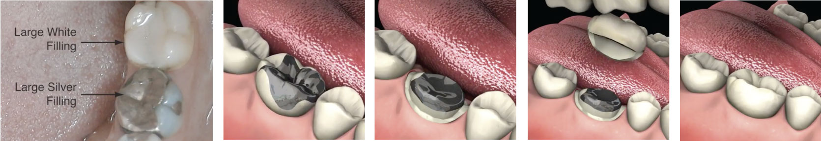 Dental Crown : A Comprehensive Guide